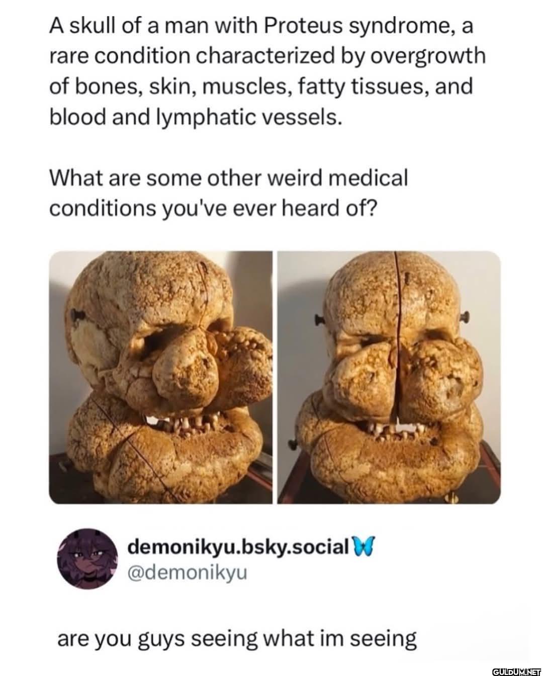 A skull of a man with Proteus syndrome, a rare condition characterized ...