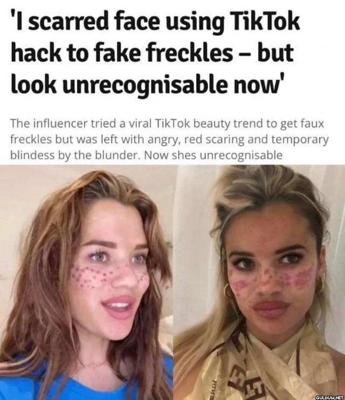 yikes 'I scarred face using TikTok hack to fake freckles - but look ...